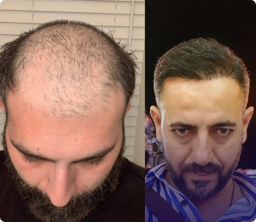 Tips for Swelling After Eyebrow Transplant - Grace Touch Clinic